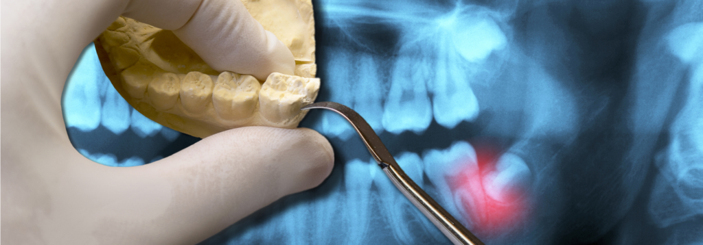 Impacted Tooth Removal - Oberoi Dental Clinic